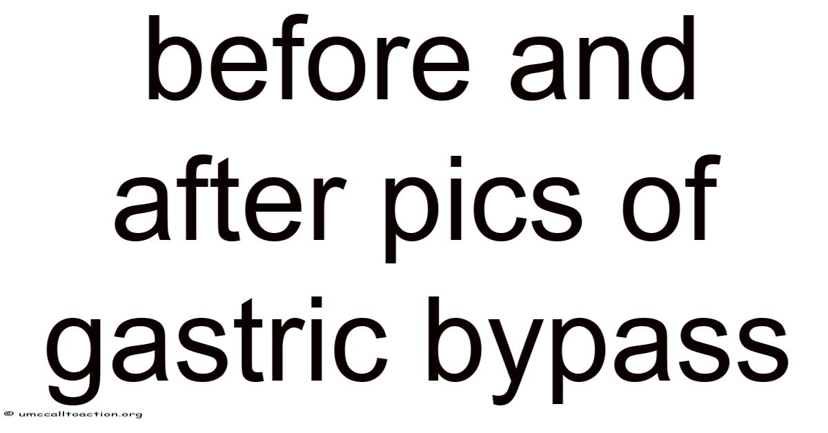 Before And After Pics Of Gastric Bypass