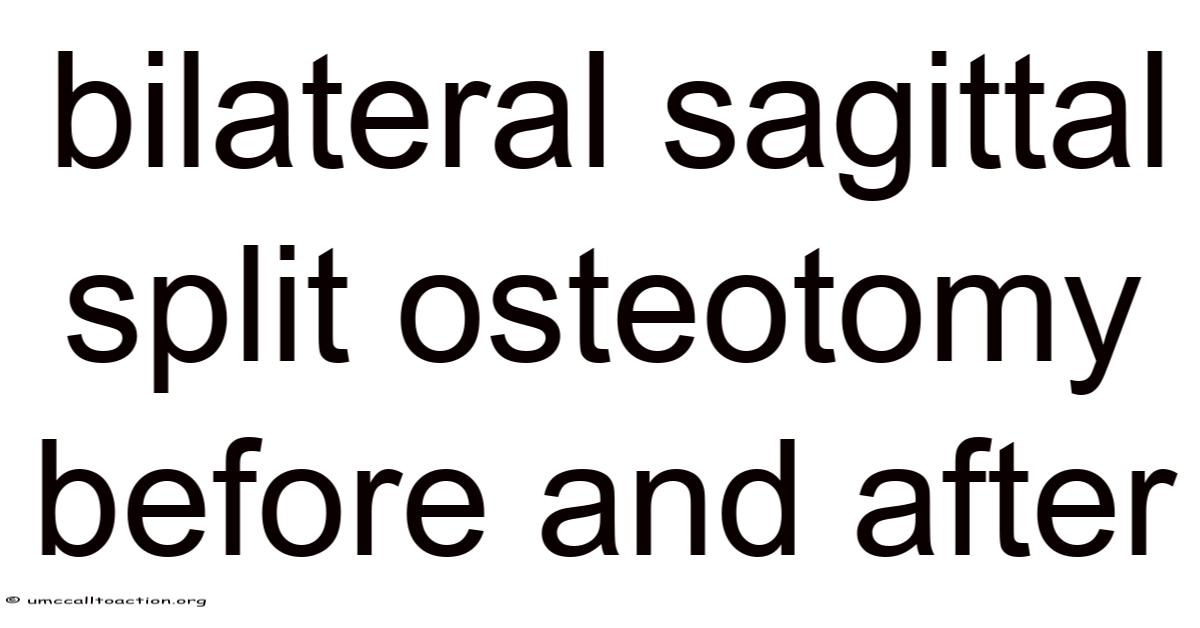 Bilateral Sagittal Split Osteotomy Before And After